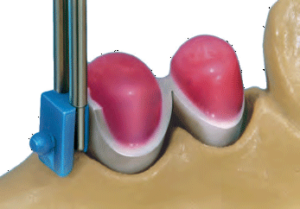 2M12-Ataches bredent