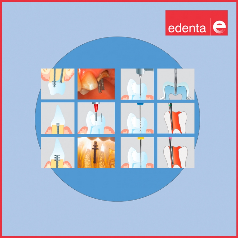 4O 6-Pines IntraRadiculares y Limas de Endodoncia Odontologo